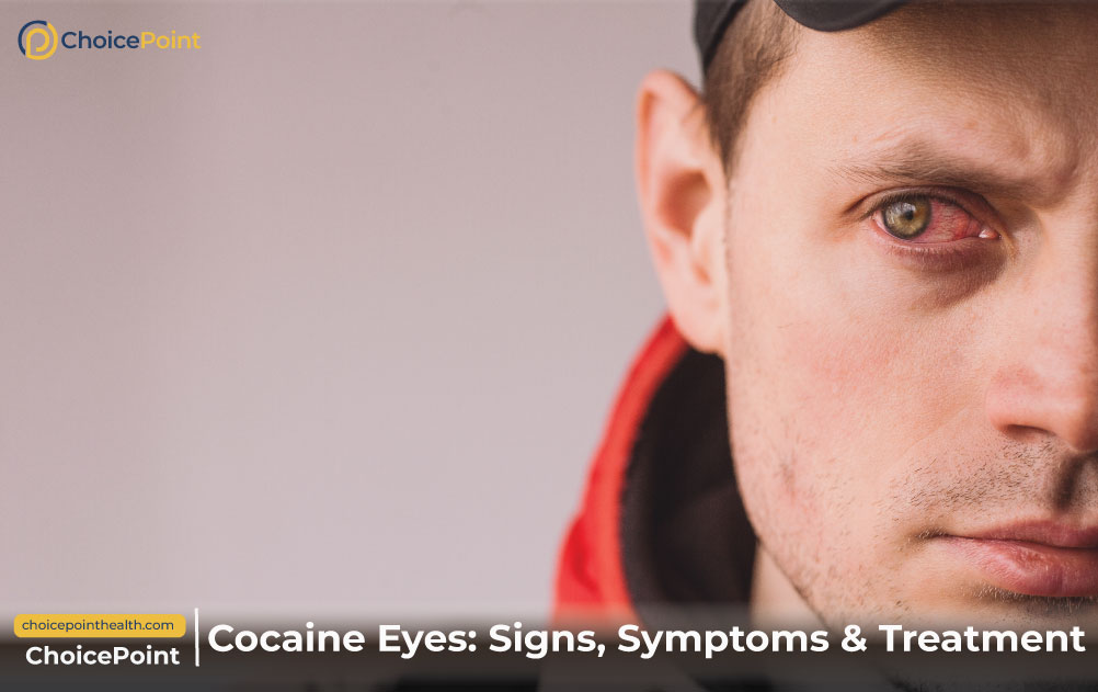 Cocaine Eyes: Signs, Symptoms & Treatment - ChoicePoint